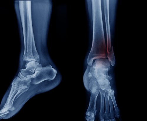 Ankle Pain: Symptoms, Causes and Treatment | STD.GOV Blog