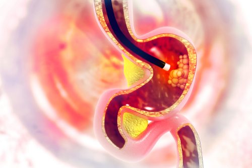 Stomach Polyps: Symptoms, Causes, Diet, Treatment | STD.GOV Blog