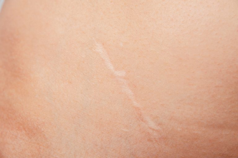 Appendicitis Symptoms In Women | STD.GOV Blog