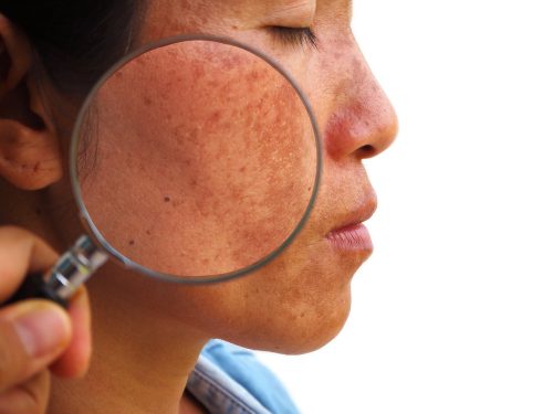 Melasma: Causes, Symptoms and Treatments | STD.GOV Blog