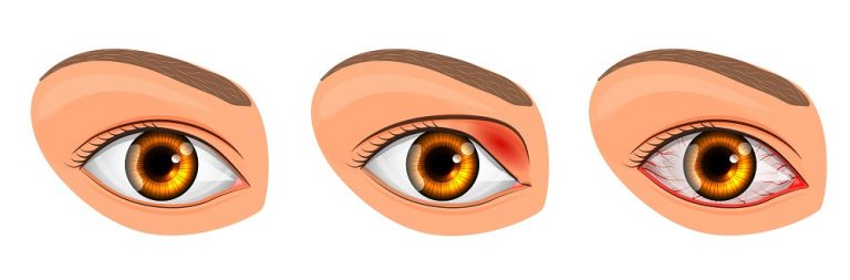 Viral Eye Infection: Types, Symptoms, Treatment | STD.GOV Blog