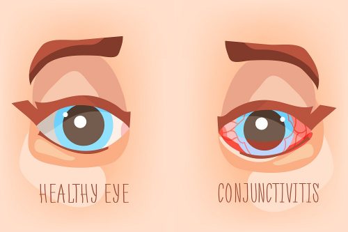 Viral Eye Infection: Types, Symptoms, Treatment | STD.GOV Blog