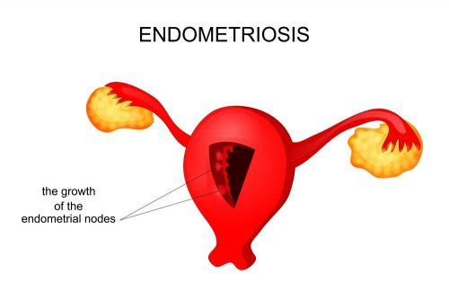 Chronic Endometritis: Causes, Symptoms, Home Remedies | STD.GOV Blog
