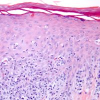 Top 5 Most Dangerous STDs and their Symptoms