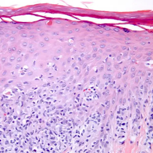 Top 5 Most Dangerous STDs and their Symptoms