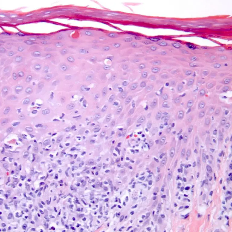 Top 5 Most Dangerous STDs and their Symptoms