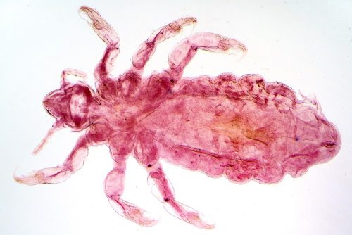 Body Lice | symptoms, diagnosis, treatment, pictures, home remedies