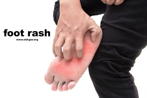 Foot rash | causes, symptoms, home remedies & treatment, pictures