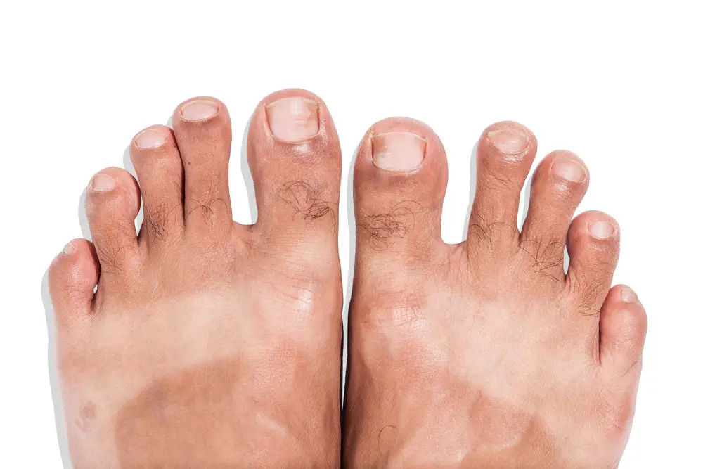 Peeling Feet Causes Symptoms Home Remedies Pictures Peeling Feet Causes Symptoms Home Remedies Pictures