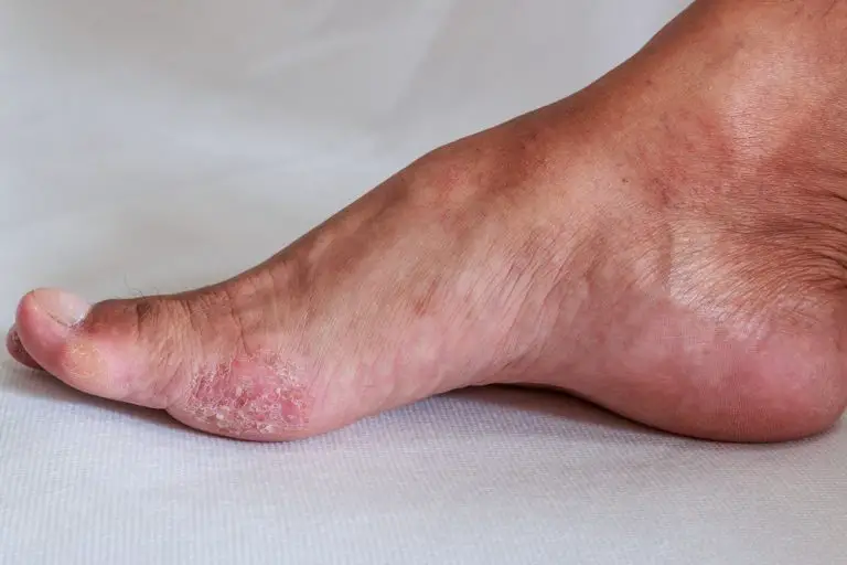 Peeling Feet | causes, symptoms, home remedies, pictures