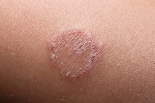 Ringworm pictures | causes & symptoms, how does it look like?