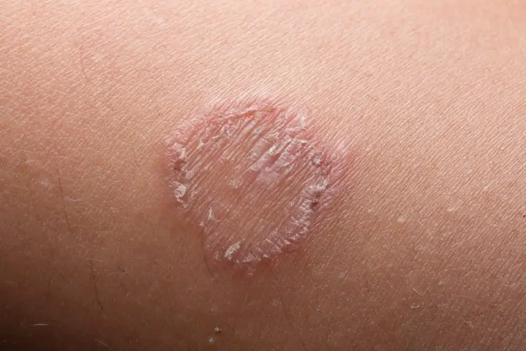 Ringworm pictures | causes & symptoms, how does it look like?