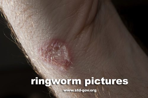 Ringworm pictures | causes & symptoms, how does it look like?