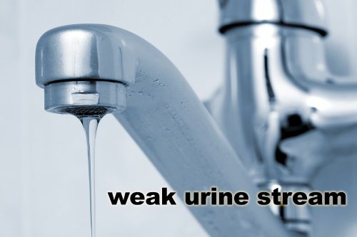Weak urine stream | reasons, treatment, male, female