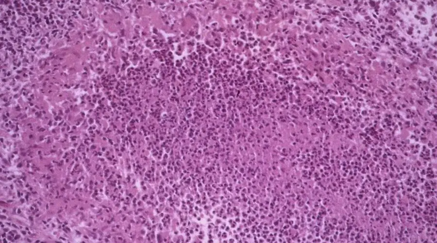 List of all STDs and their Symptoms