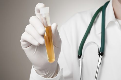 Dark Urine | Causes, What Does it Mean, What to Do, FAQs